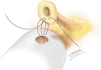 Bentall Procedure | SpringerLink