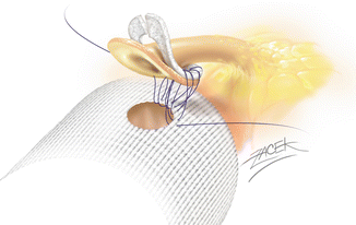 Bentall Procedure | SpringerLink