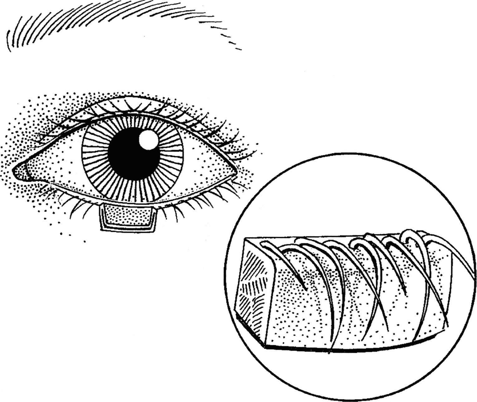 Trichiasis and Distichiasis | SpringerLink
