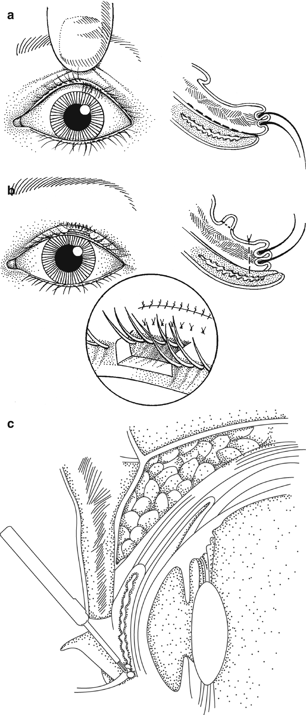Trichiasis and Distichiasis | SpringerLink