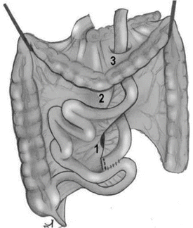 Internal Hernia and Small Bowel Obstruction After Roux-en-Y Gastric ...