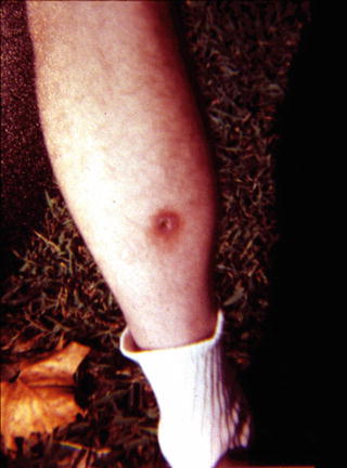 Necrotic Arachnidism: Brown Recluse Bites | SpringerLink