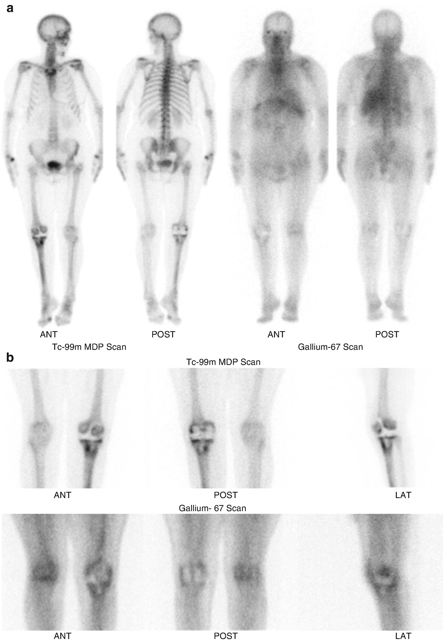 Radionuclide Imaging of Skeletal Implants | SpringerLink