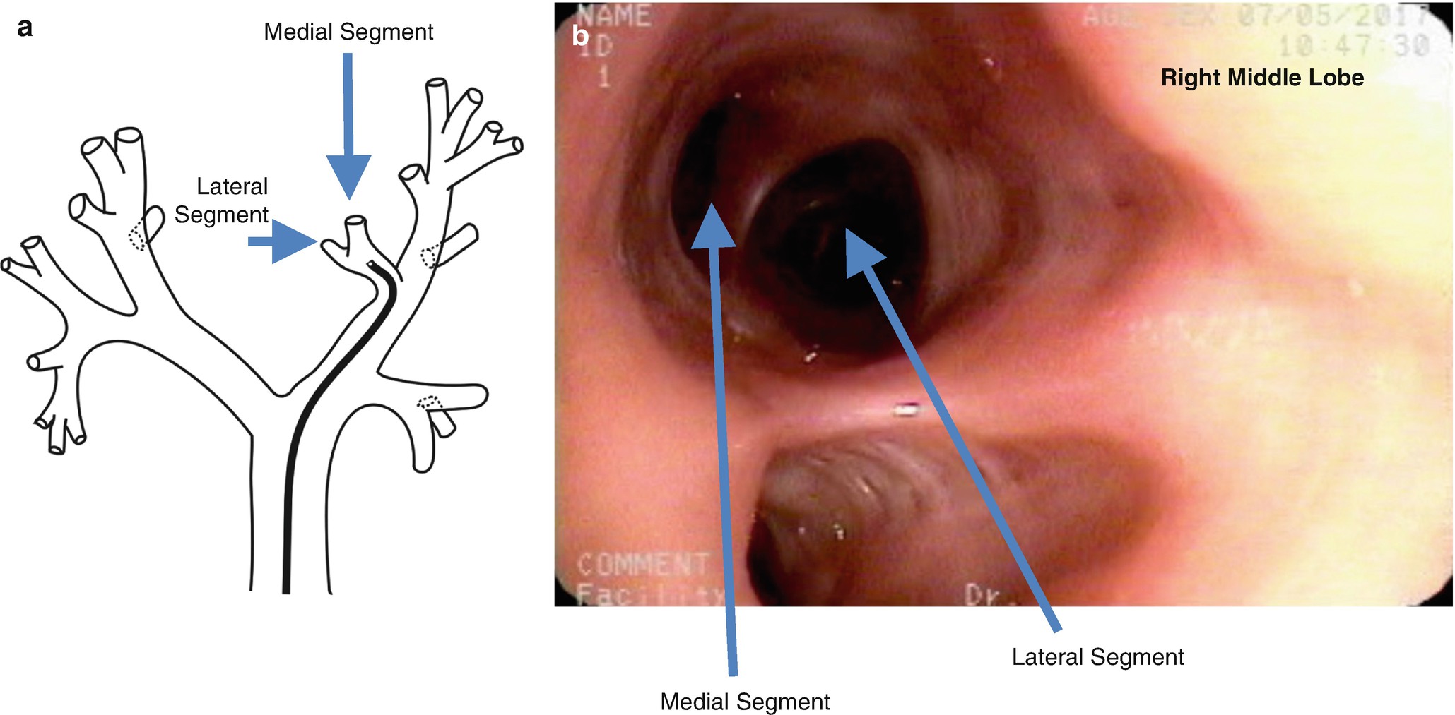 Bronchoscopy in the Intensive Care Unit | SpringerLink