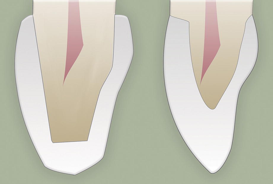 Fundamentals of Tooth Preparation | SpringerLink