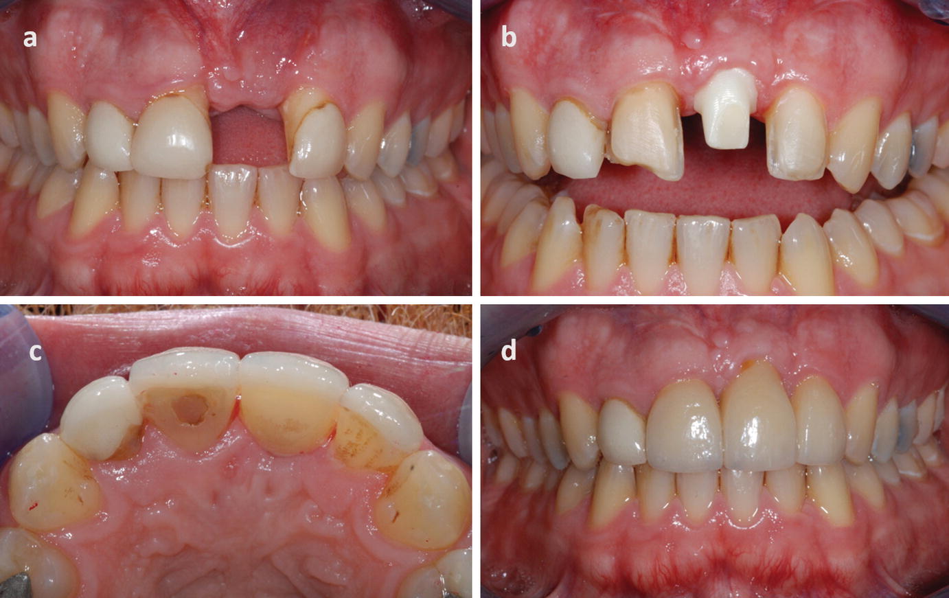 Fundamentals of Tooth Preparation | SpringerLink