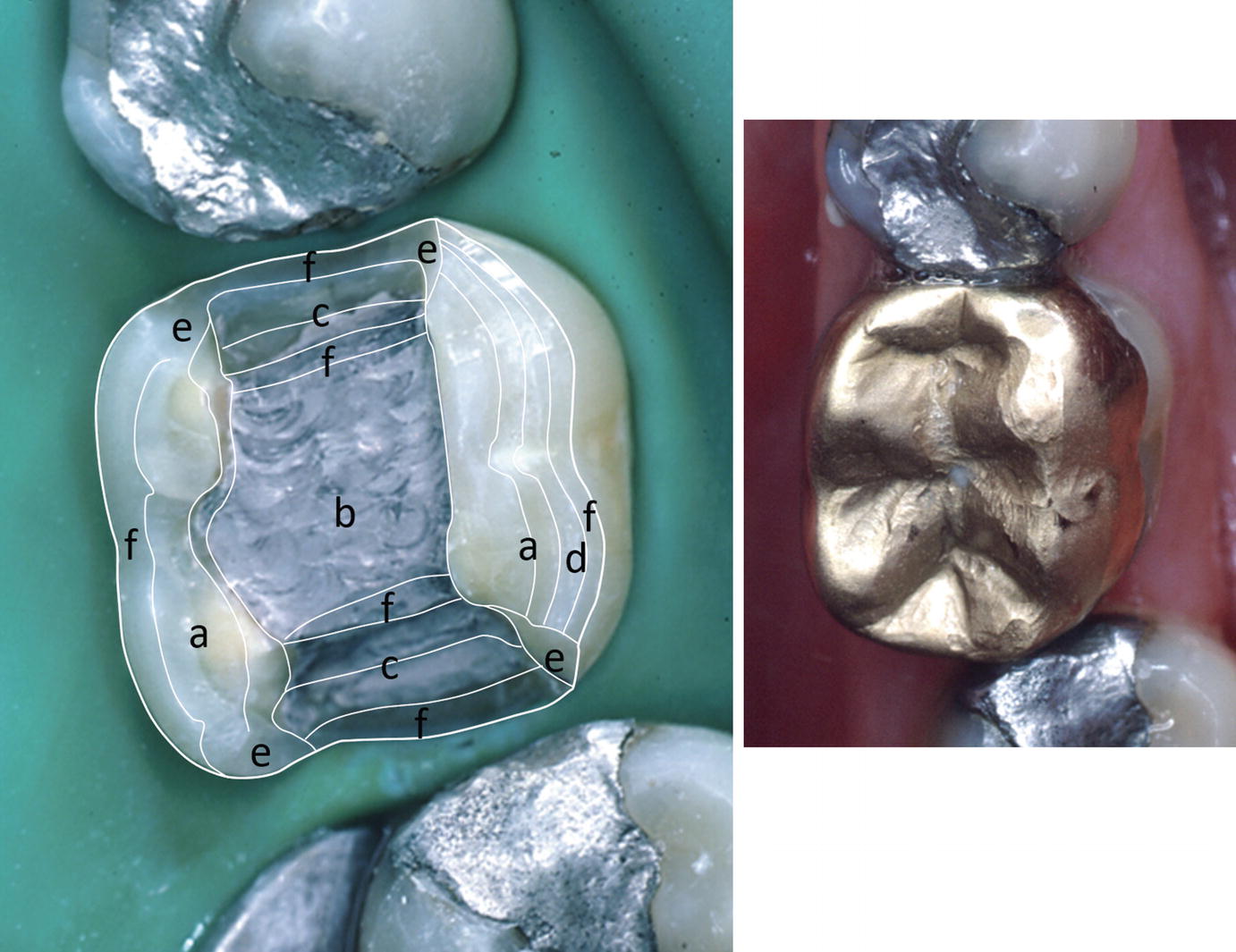 Fundamentals of Tooth Preparation | SpringerLink
