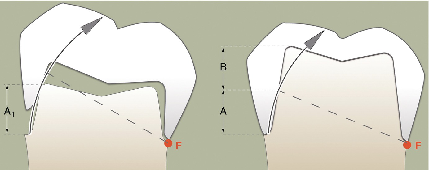 Fundamentals of Tooth Preparation | SpringerLink
