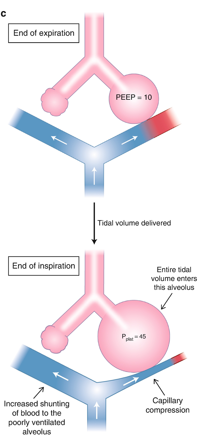 Acute Respiratory Distress Syndrome | SpringerLink