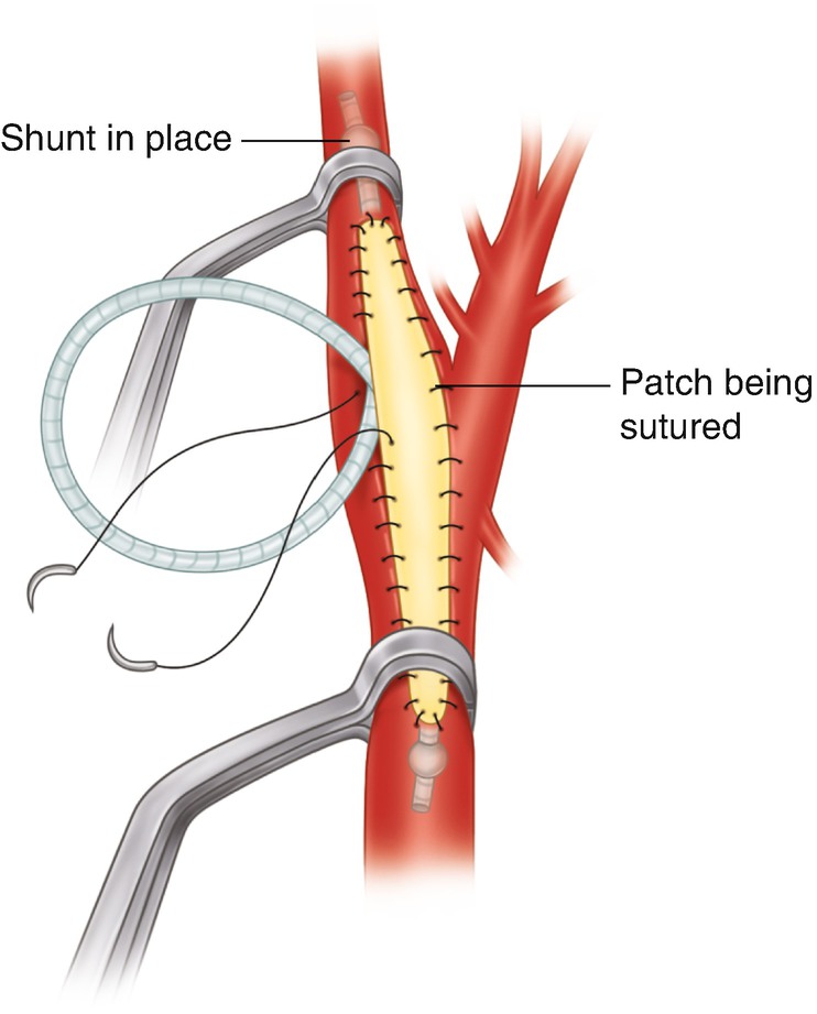 Carotid Endarterectomy | SpringerLink