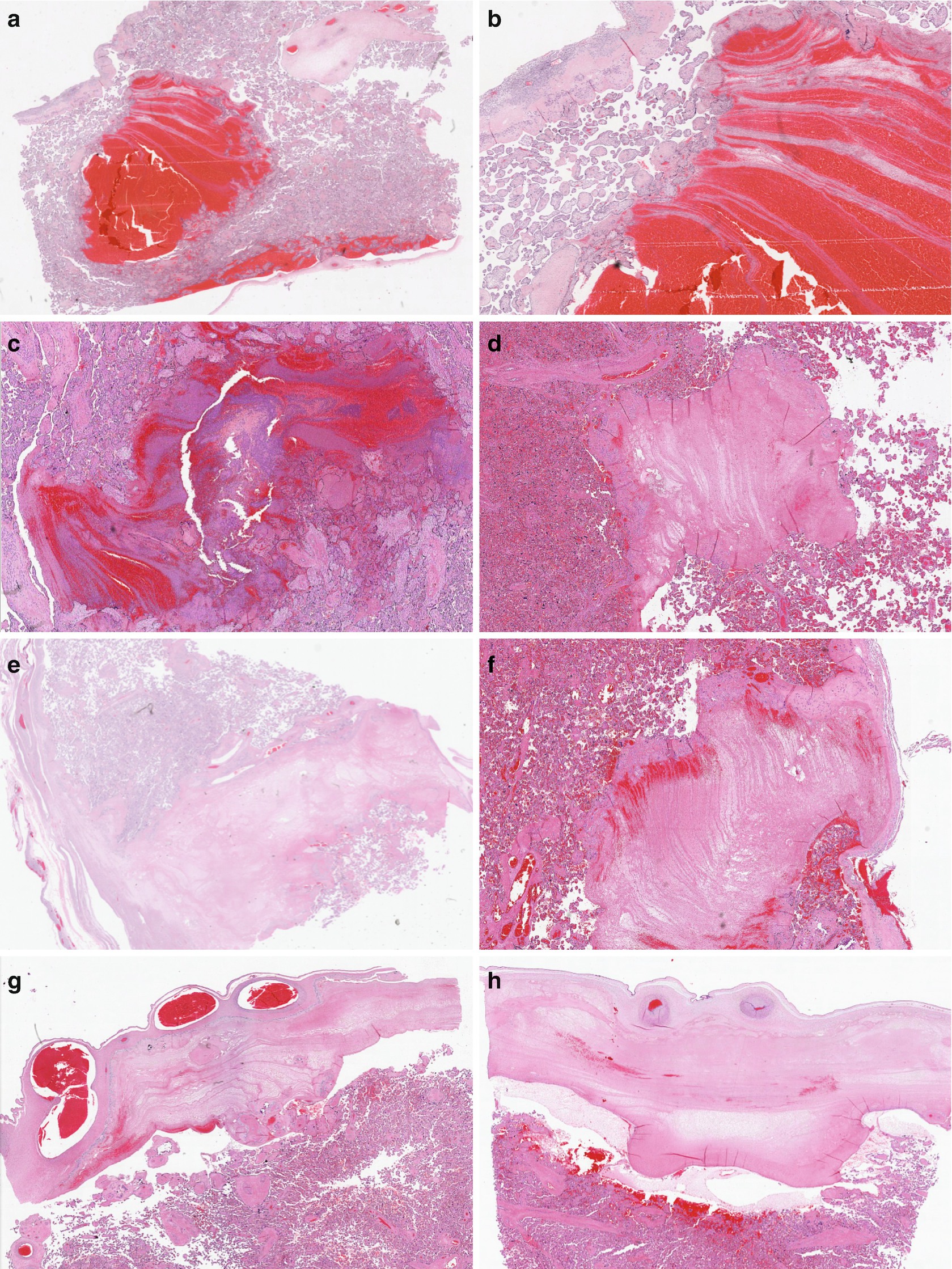 Intervillous Thrombosis | SpringerLink