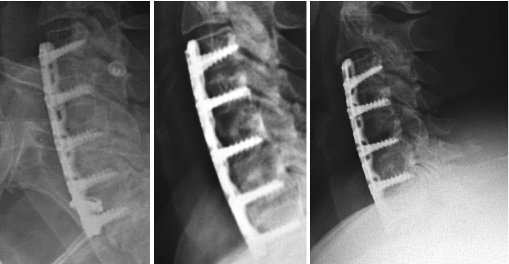 Multilevel ACDF Versus Corpectomy | SpringerLink