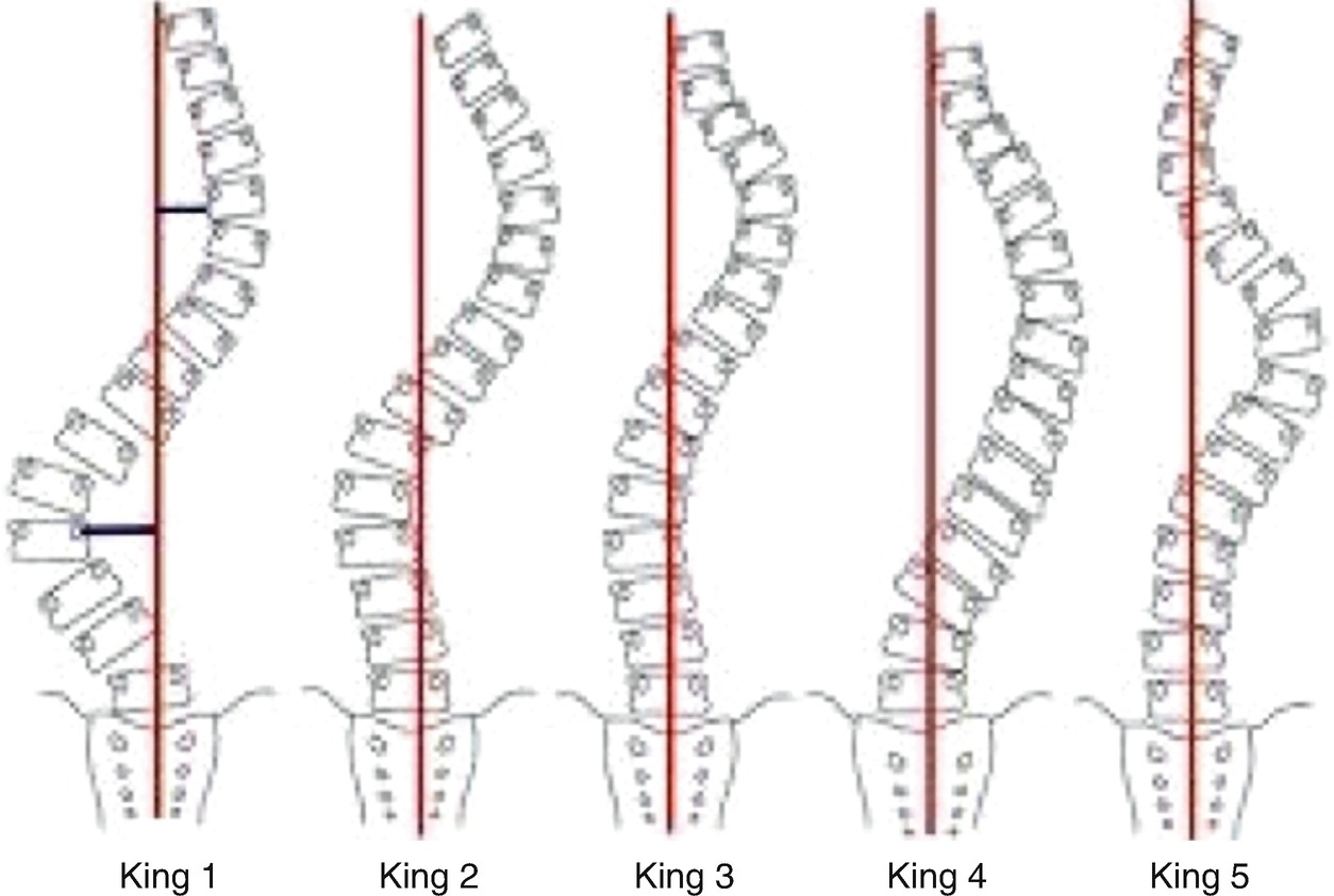 Natural Course and Classification of Idiopathic Scoliosis | SpringerLink