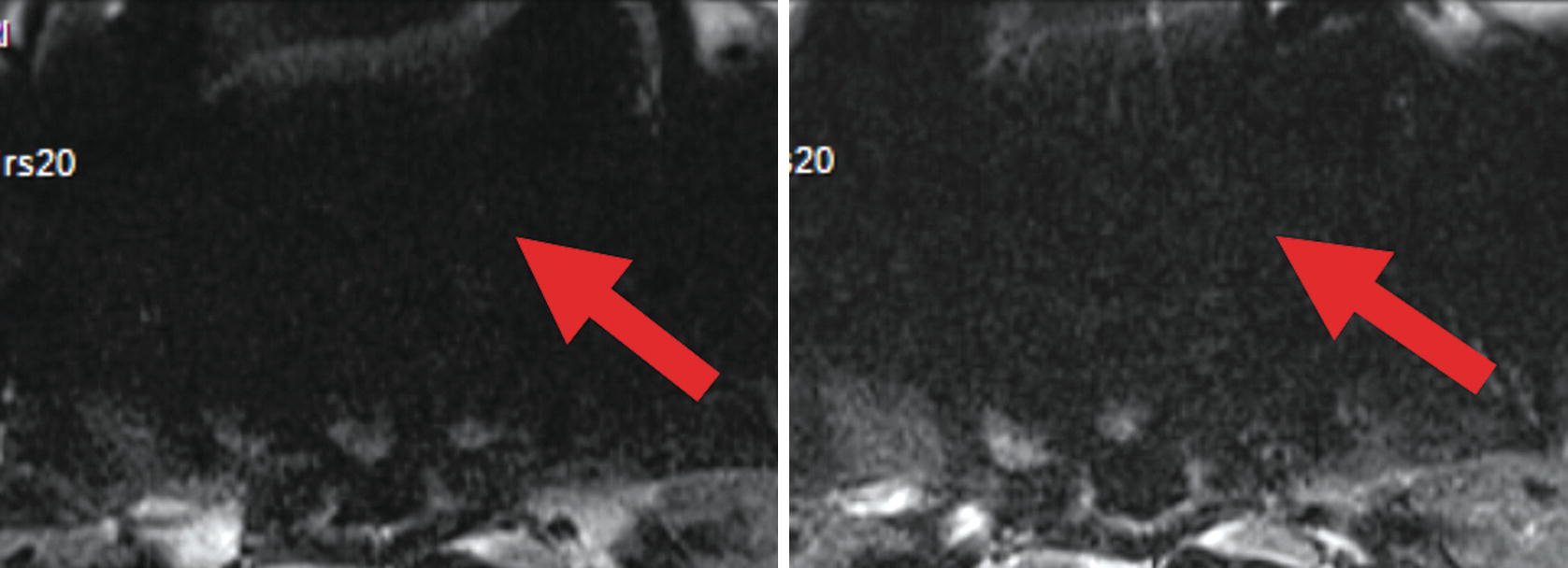 Upper Cervical Spine Trauma | SpringerLink