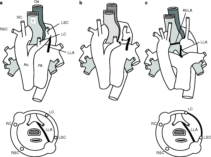 Aortic Arch Anomalies, Tracheal Compression and Stenosis | SpringerLink