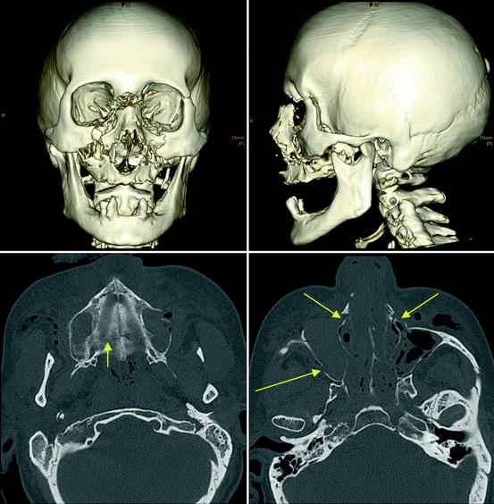 Classification of Craniofacial Fractures | SpringerLink