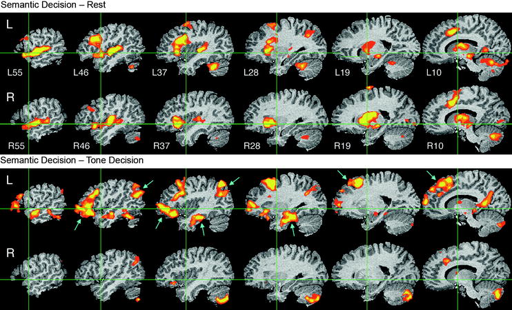 Use of fMRI Language Lateralization for Quantitative Prediction of ...
