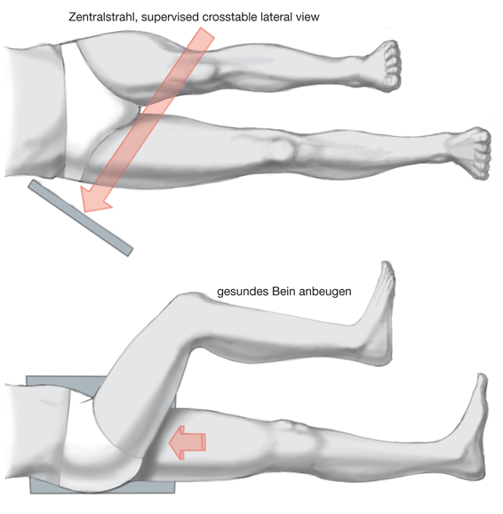 Schenkelhalsfrakturen | SpringerLink