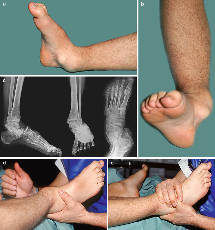 Ligamente: Rupturen und Luxationen | SpringerLink