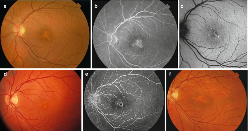 Retinal Dystrophies Associated with the PRPH2 Gene | SpringerLink