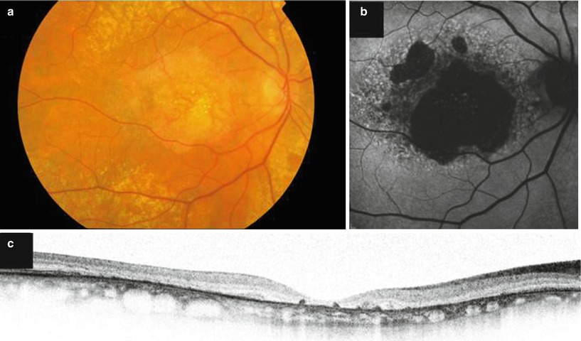Retinal Dystrophies Associated with the PRPH2 Gene | SpringerLink