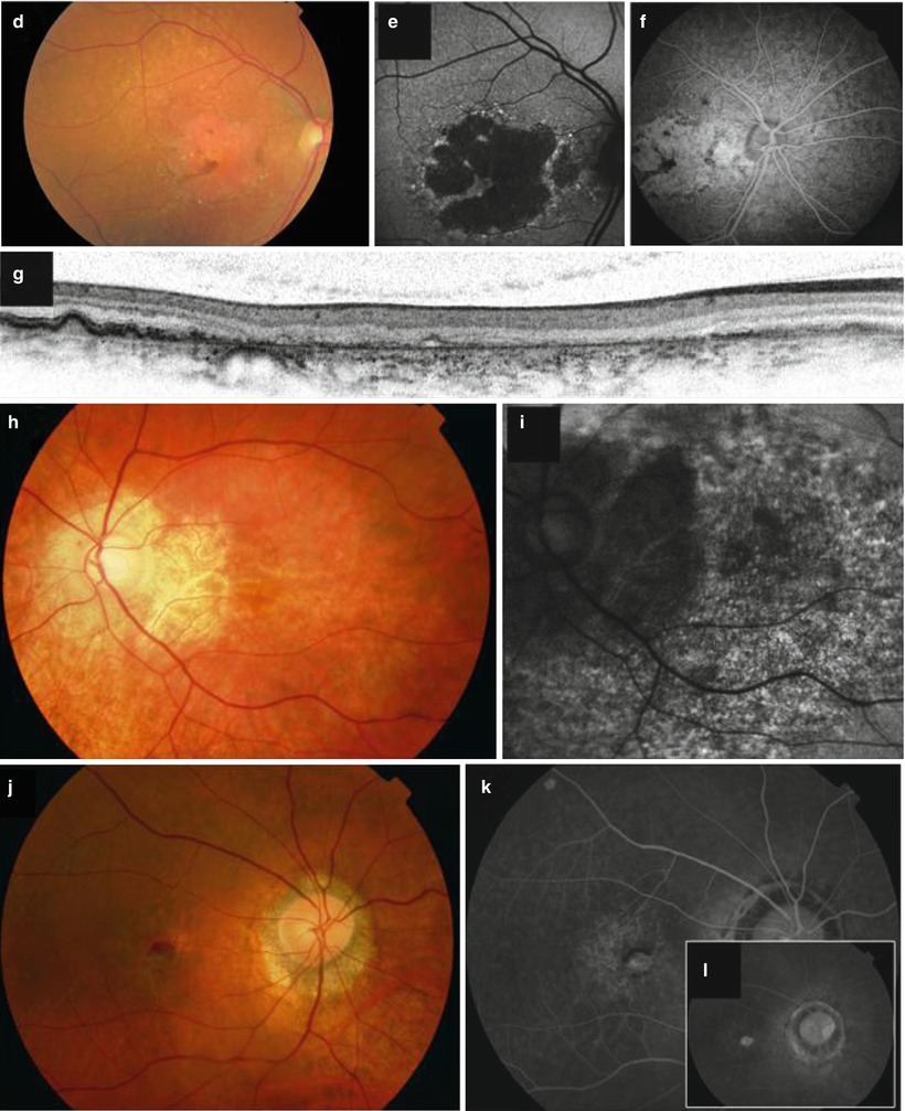 Retinal Dystrophies Associated with the PRPH2 Gene | SpringerLink