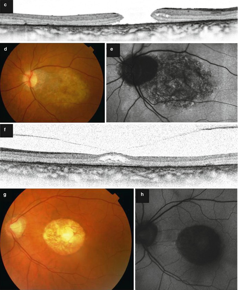 Retinal Dystrophies Associated with the PRPH2 Gene | SpringerLink