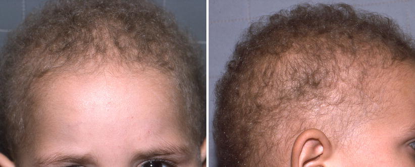 Congenital Hypotrichosis with Juvenile Macular Dystrophy | SpringerLink