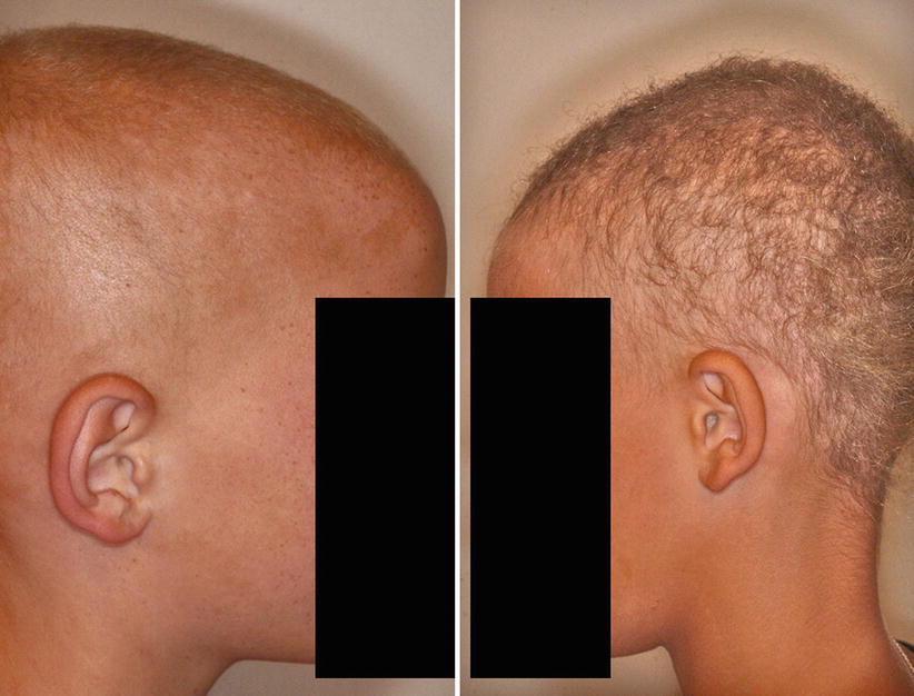 Congenital Hypotrichosis with Juvenile Macular Dystrophy | SpringerLink