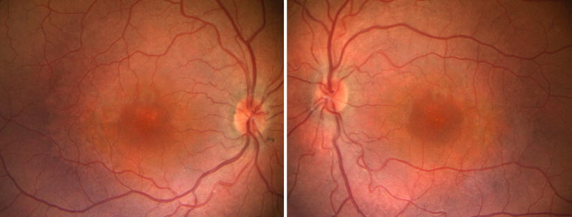 Congenital Hypotrichosis with Juvenile Macular Dystrophy | SpringerLink