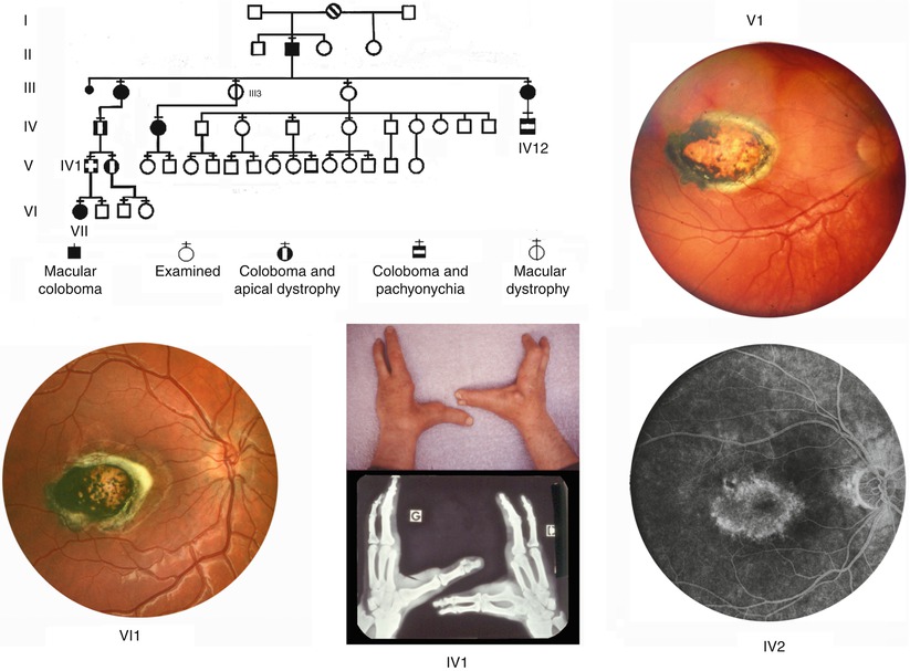 Congenital Hypotrichosis with Juvenile Macular Dystrophy | SpringerLink