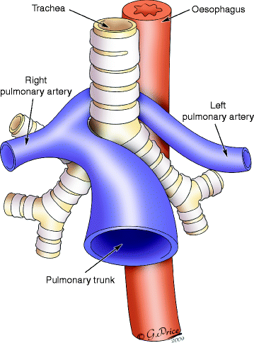 Left Pulmonary Artery Sling | SpringerLink