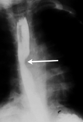 Left Pulmonary Artery Sling | SpringerLink