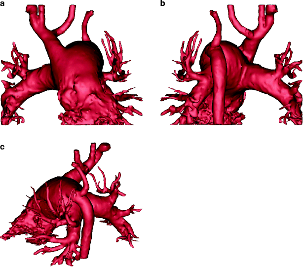Common Arterial Trunk | SpringerLink