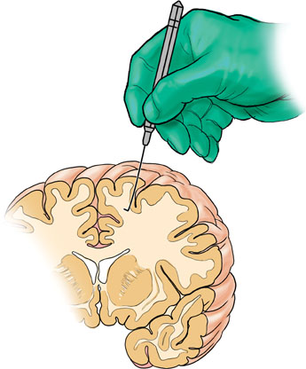 Subpial Transection | SpringerLink