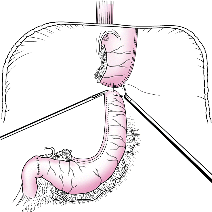 Esophagus and Diaphragm | SpringerLink