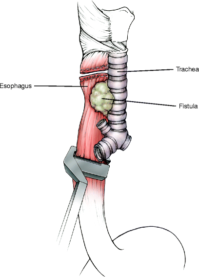 Esophagus and Diaphragm | SpringerLink