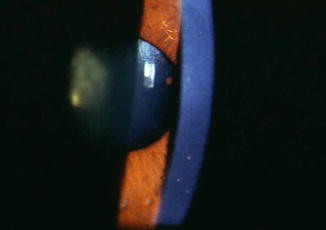 Posner-Schlossman Syndrome | SpringerLink