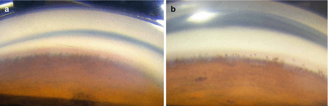 Posner-Schlossman Syndrome | SpringerLink