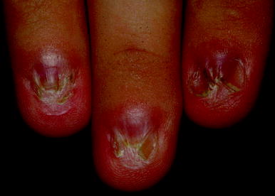 Nail Lichen Planus | SpringerLink