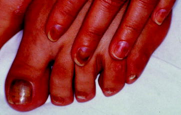 Drug-Induced Nail Abnormalities | SpringerLink