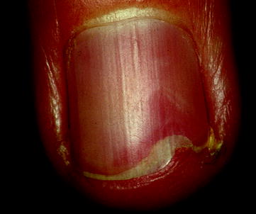 Nail Thinning | SpringerLink