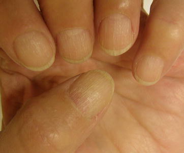 Nail Thinning | SpringerLink