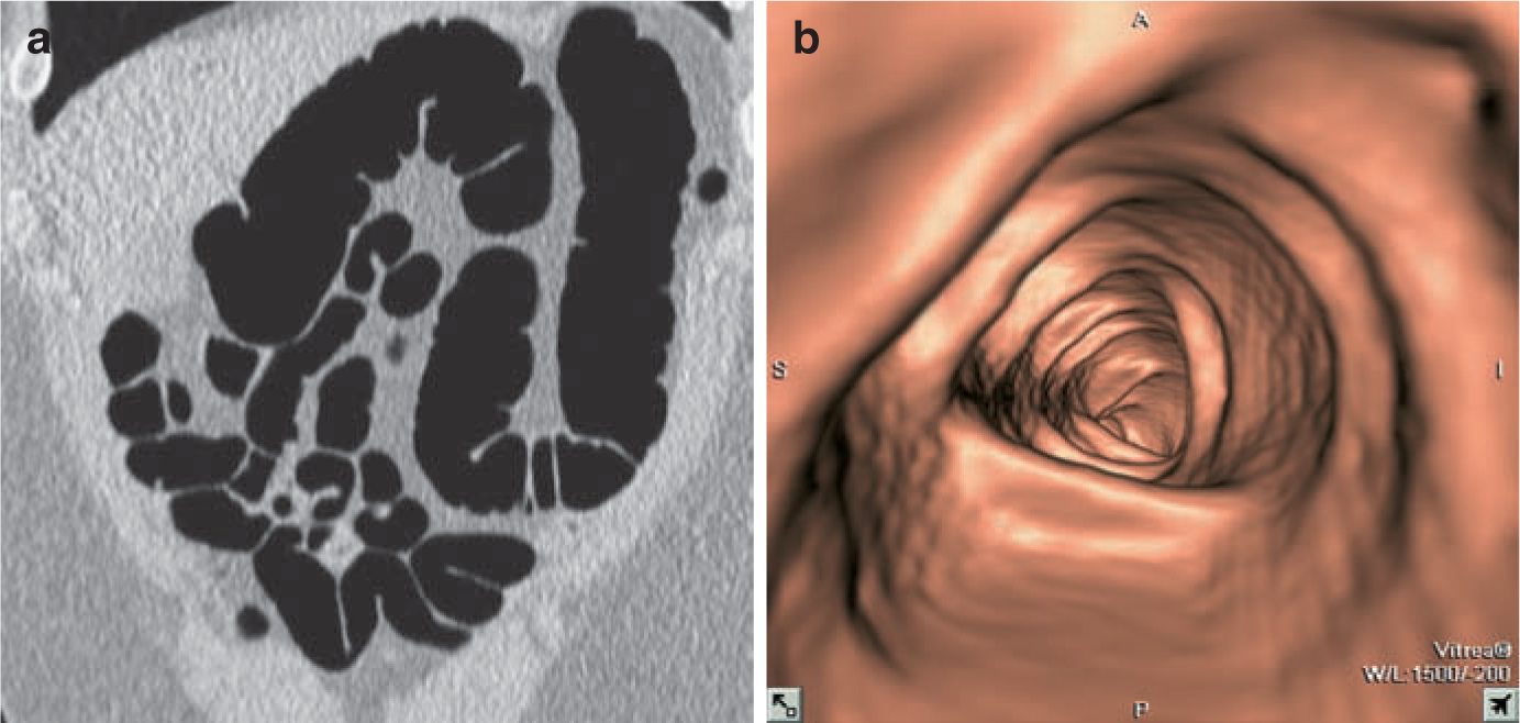Patient Preparation for CT Colonography | SpringerLink