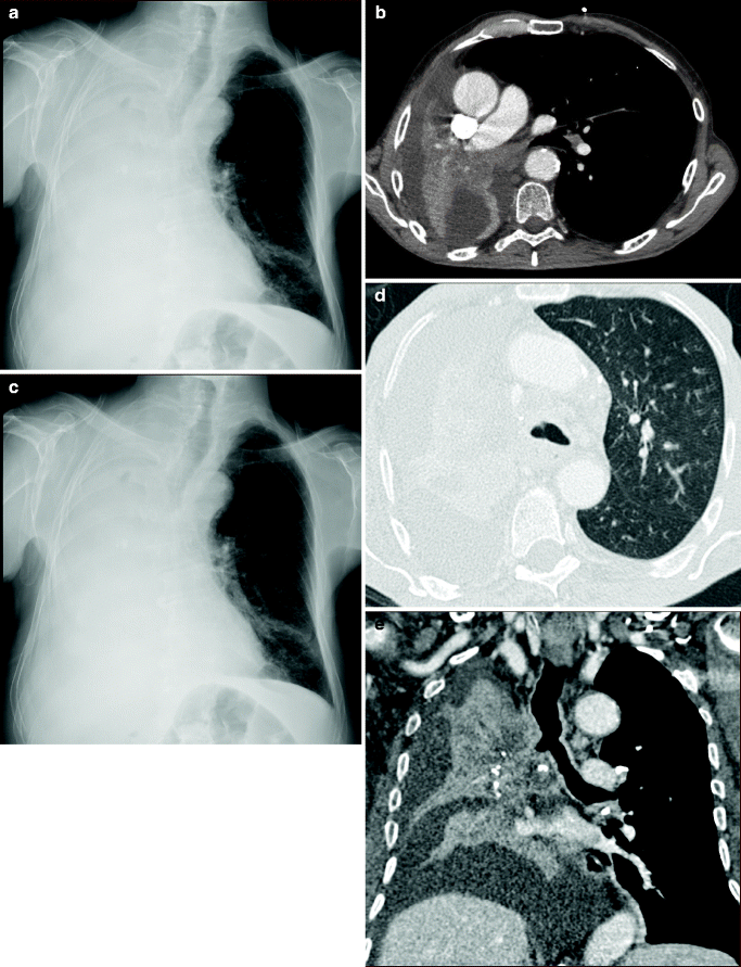 Atelectasis | SpringerLink