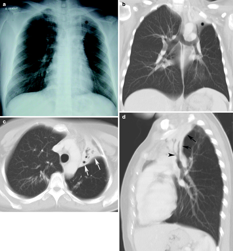 Atelectasis | SpringerLink
