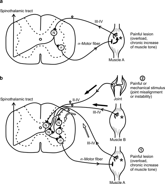 Increased Muscle Tone as a Cause of Muscle Pain | SpringerLink