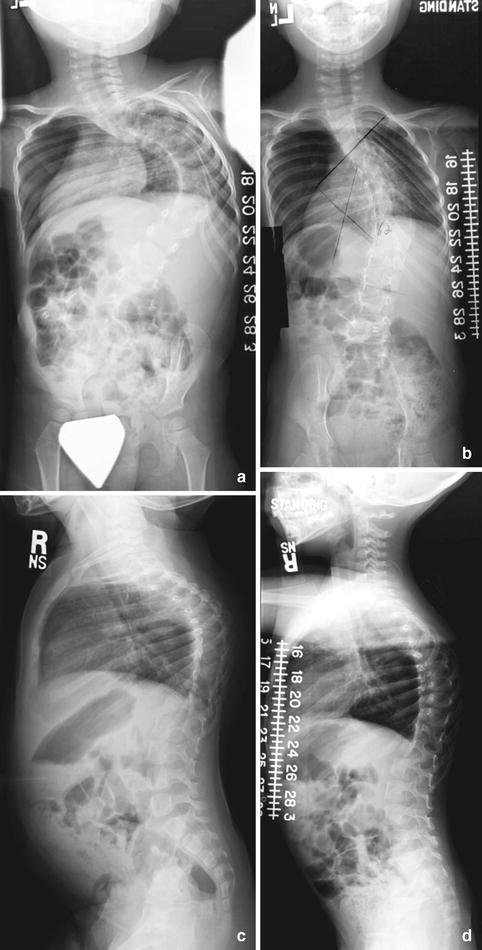 Halo-Gravity Traction | SpringerLink