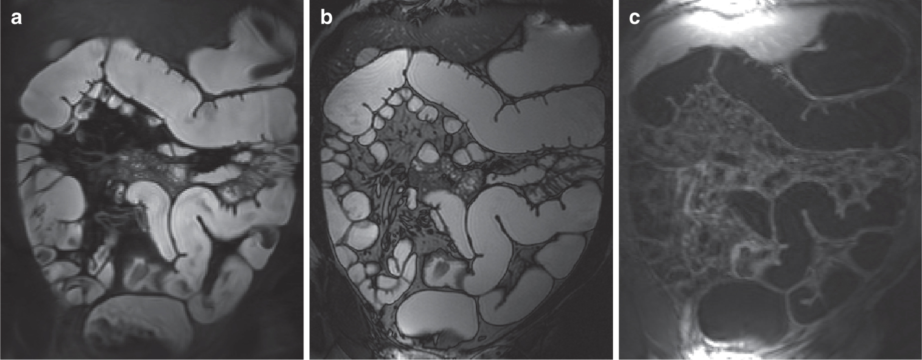 MRI of the Colon (MR Colonography): Technique | SpringerLink