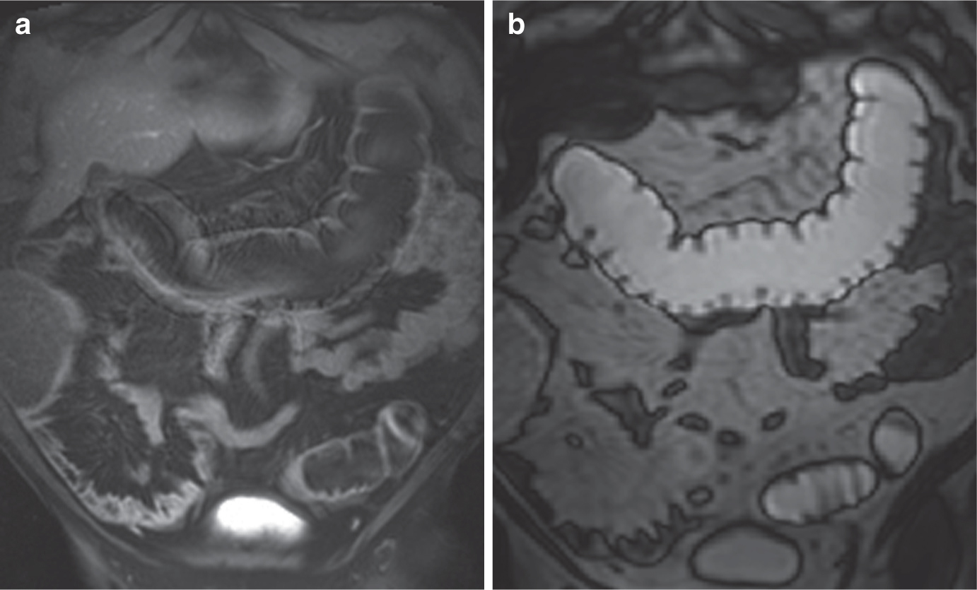 MRI of the Colon (MR Colonography): Technique | SpringerLink